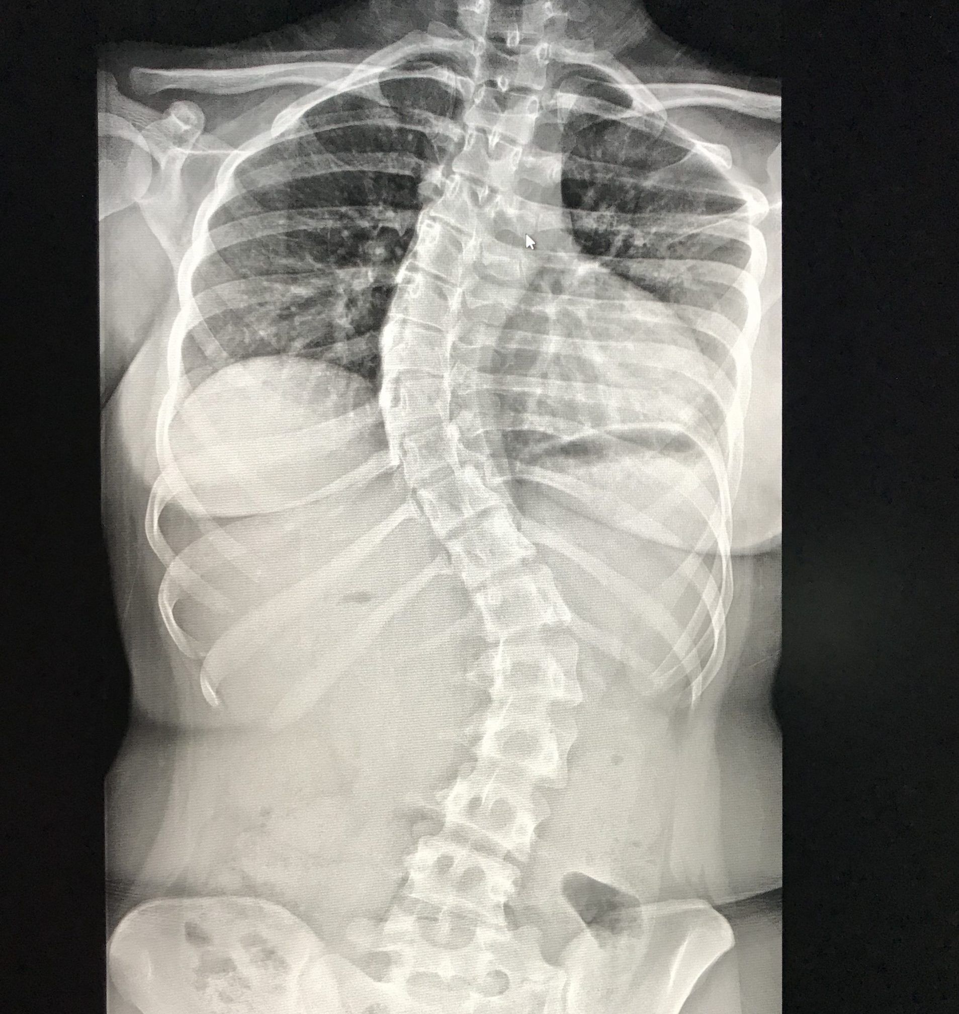 Algunos datos sobre la escoliosis - Hospitales Puerta de Hierro
